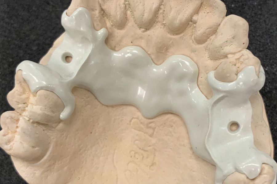 Metallfreie Klammerprothesen - Roland Katzer Zahntechnik GmbH